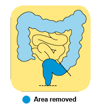 Surgery for Cancer in the Rectum | Cancer Council NSW