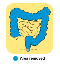 Surgery for Cancer in the Colon | Cancer Council NSW