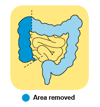 Surgery for Cancer in the Colon | Cancer Council NSW