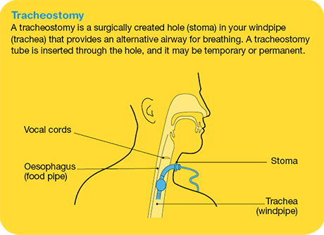 Breathing Changes | Head & Neck Cancer | Cancer Council NSW