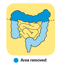Surgery for Cancer in the Colon | Cancer Council NSW