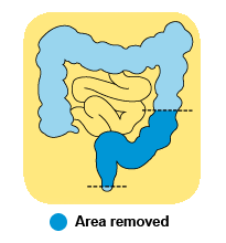 Surgery for Cancer in the Rectum | Cancer Council NSW