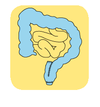 Surgery for Cancer in the Rectum | Cancer Council NSW