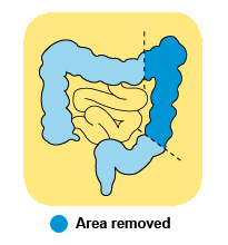 Surgery for Cancer in the Colon | Cancer Council NSW