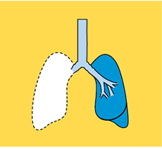 Surgery for Lung Cancer | Cancer Council NSW