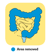 Surgery for Cancer in the Colon | Cancer Council NSW