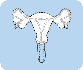 Surgery for Ovarian Cancer Treatment | Cancer Council NSW