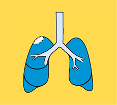 Surgery for Lung Cancer | Cancer Council NSW