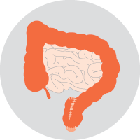 Surgery for Cancer in the Rectum | Cancer Council NSW