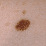The Signs of Skin Cancer | Cancer Council NSW