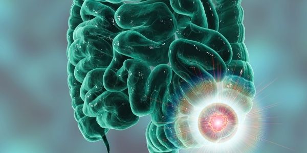 Extending treatment success in pancreatic and bowel cancers | Cancer ...