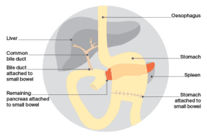 Having a Whipple Procedure | Pancreatic Cancer | Cancer Council NSW