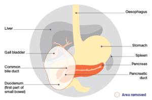 Having a Whipple Procedure | Pancreatic Cancer | Cancer Council NSW