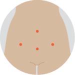 Surgery for Cancer of the Uterus | Cancer Council NSW