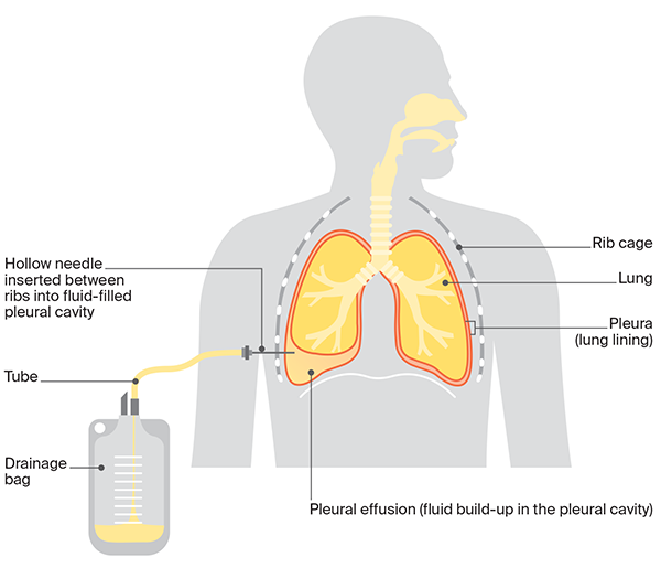 Managing Breathlessness for Pleural Mesothelioma | Cancer Council NSW