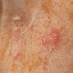 The Signs of Skin Cancer | Cancer Council NSW