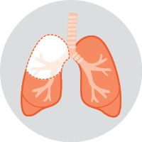 Surgery for Lung Cancer | Cancer Council NSW