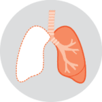Surgery for Lung Cancer | Cancer Council NSW