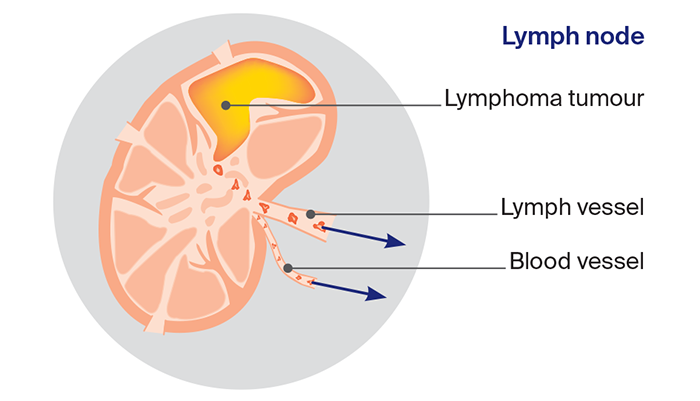 About lymphoma | Cancer Council NSW